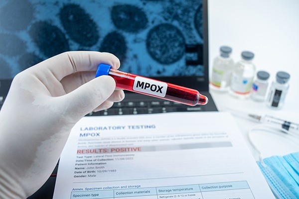 California Confirms First Clade I Mpox Case - NACCHO